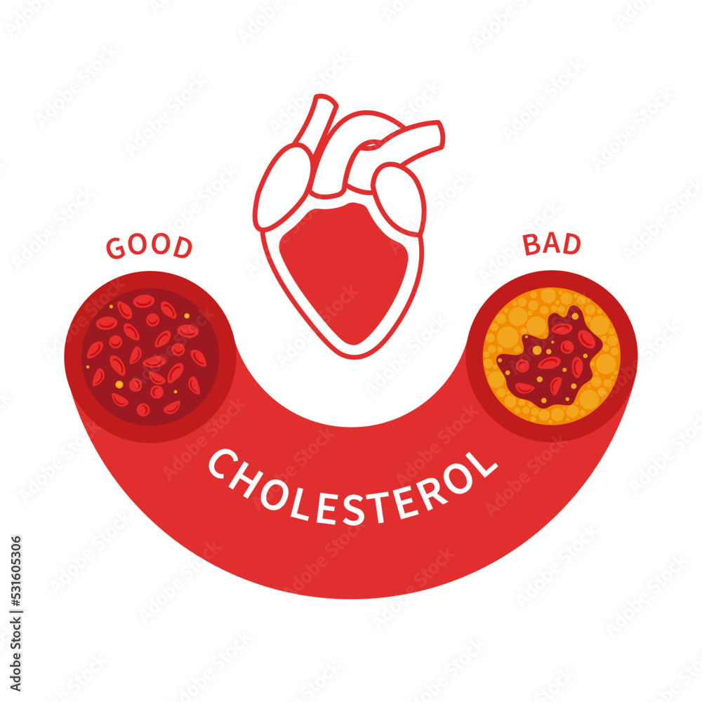 Vektor Good and bad cholesterol levels in blood vessel medical diagram ...