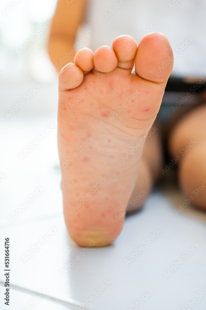 Enterovirus Leg - arm - mouth. Rash on the body of a child. Cocksackie ...