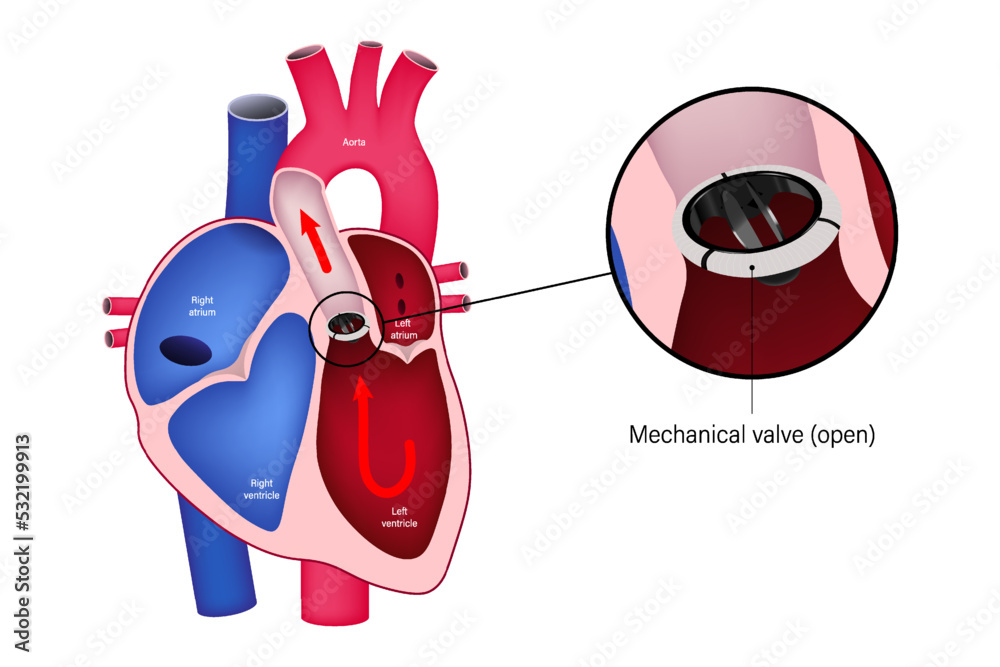 Aortic valve replacement with mechanical valve. Close up of closed ...