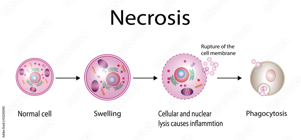 Necrosis, Pathologic Cell Death, Death of the body tissues, Cell injury ...