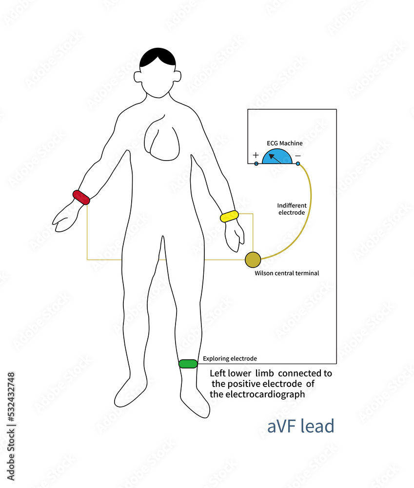Stock-Illustration „The positive pole of aVF lead is placed on the left ...