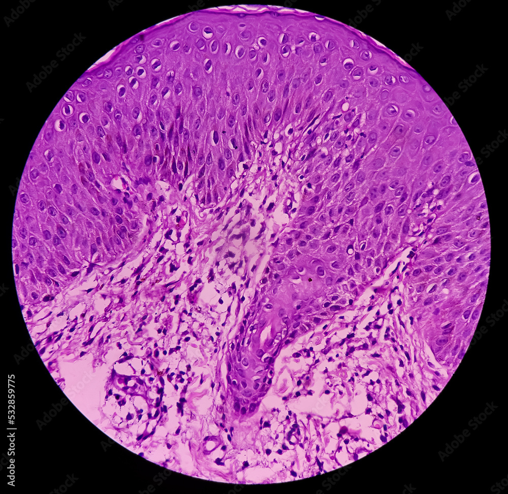 Skin tissue(biopsy): Pityriasis lichenoids chronica, a group of rare ...