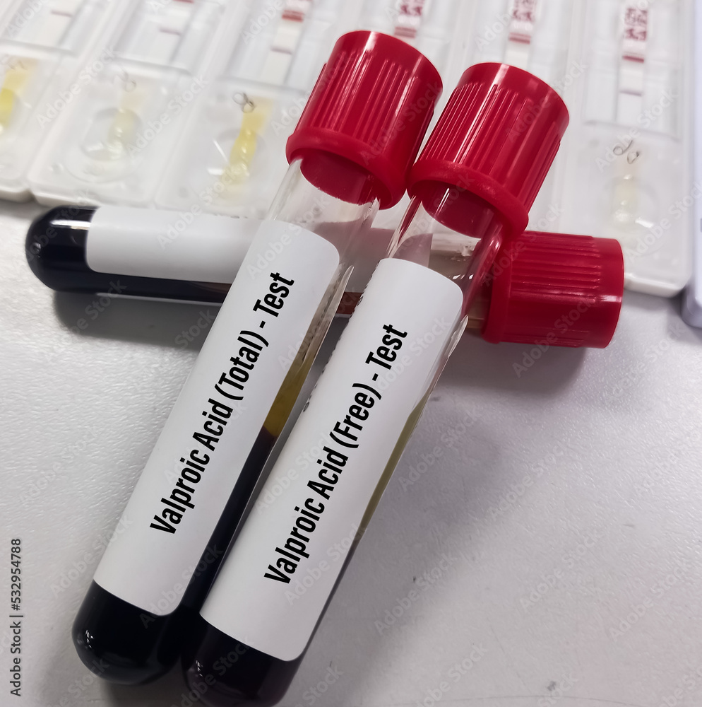 Blood sample for Valporic Acid(total and free) test. for maintain a ...