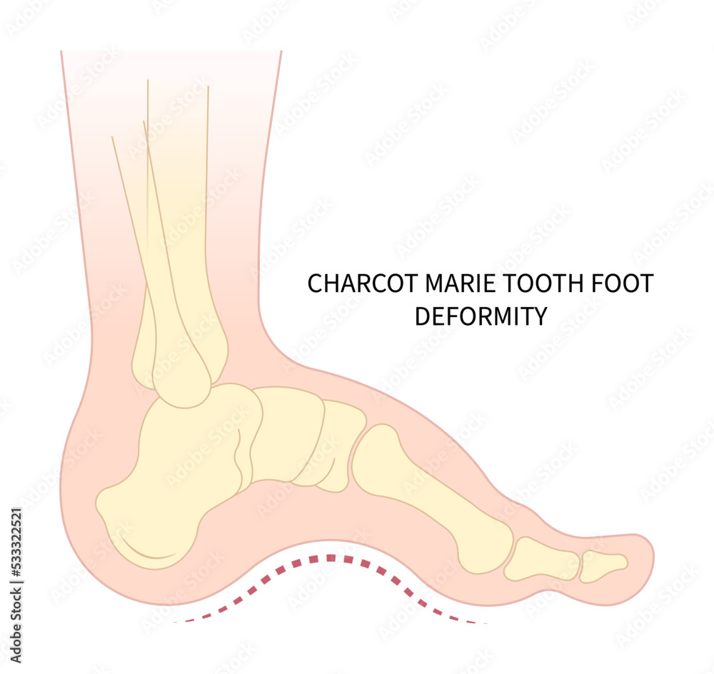 Charcot foot anatomy Bone fracture painful and diabetic gout disease ...