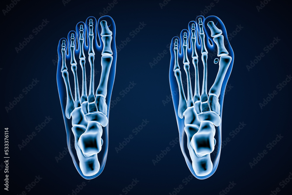 Hallux Valgus or bunion x-ray 3D rendering illustration. Dorsal or top ...