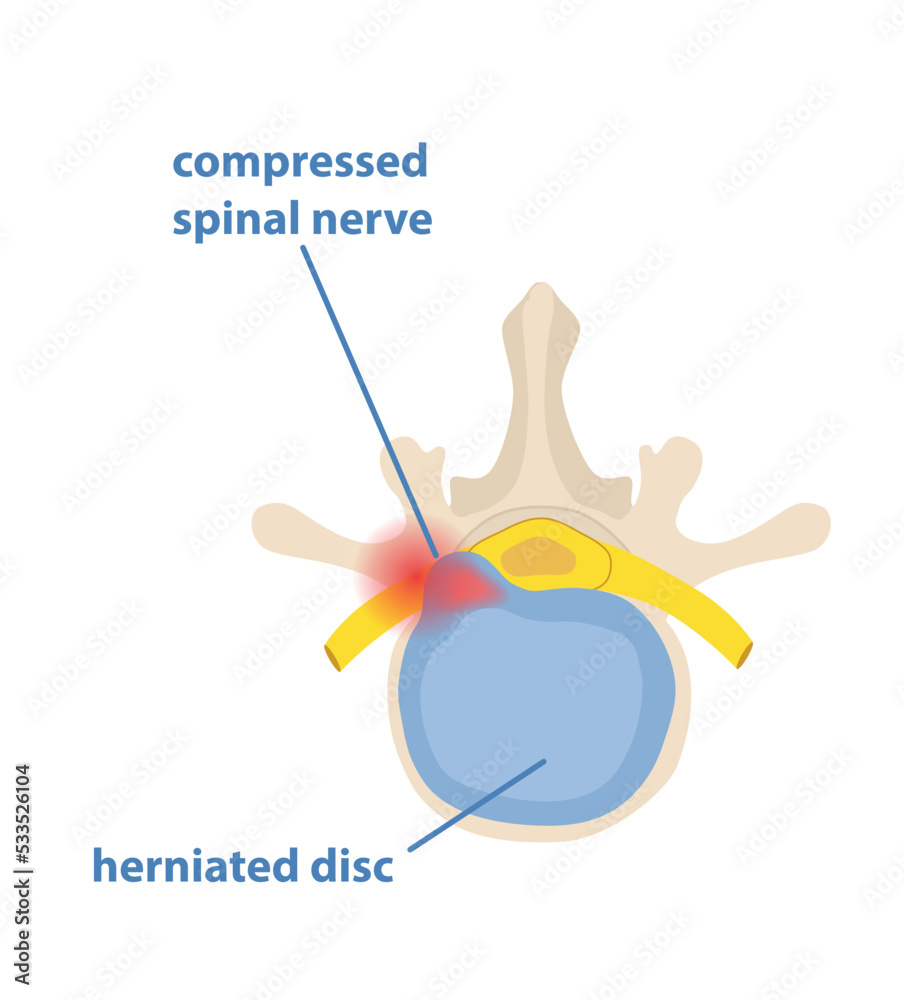 Sciatic nerve pinching concept. Compression of spinal nerve in lumbar ...