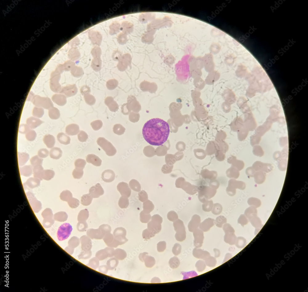 Burkitt's lymphoma cells, is a cancer of the lymphatic system, a ...