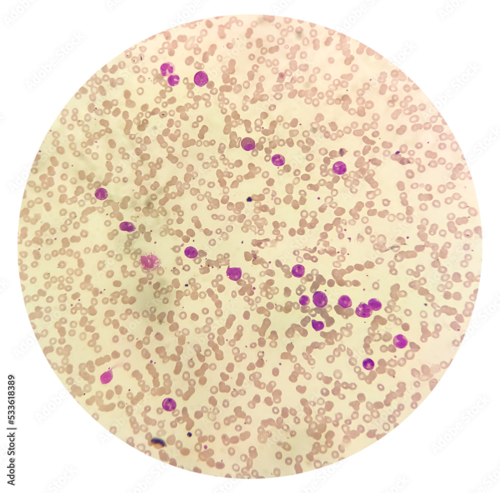 Microscopic image showing Chronic myeloid leukaemia (CML) is a type of ...