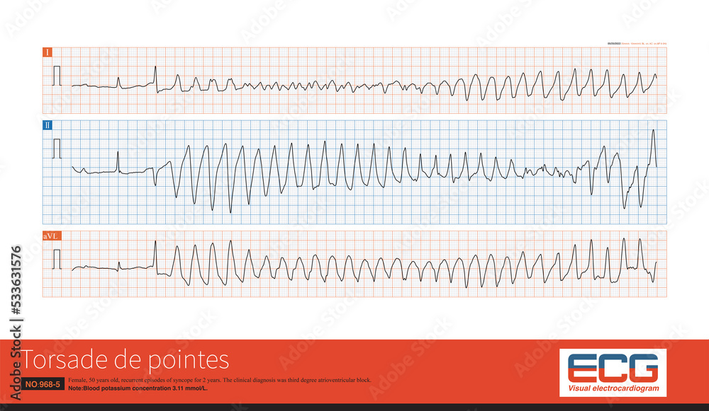 Torsade de pointes refers to the pleomorphic ventricular tachycardia ...