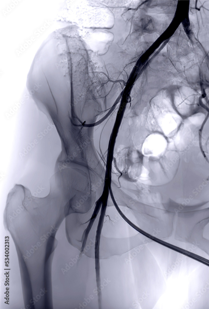 Femoral Angiogram of femoral artery. Stock Illustration | Adobe Stock