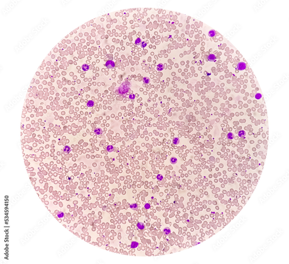 Chronic myelogenous leukemia (CML), also known as chronic myeloid ...