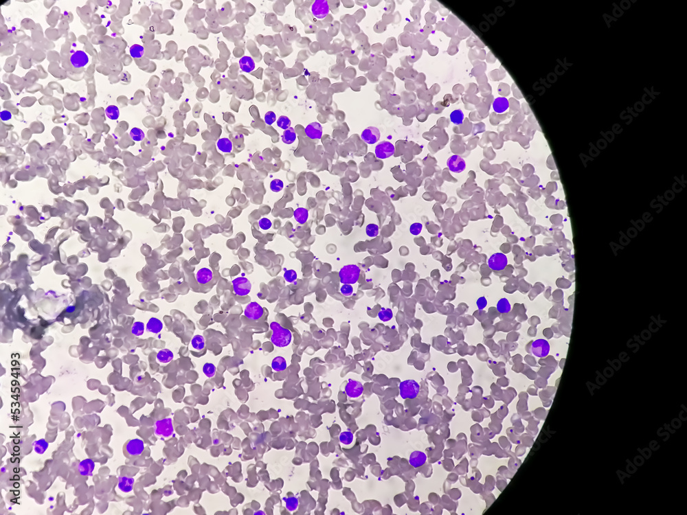 Chronic myelogenous leukemia (CML), also known as chronic myeloid ...