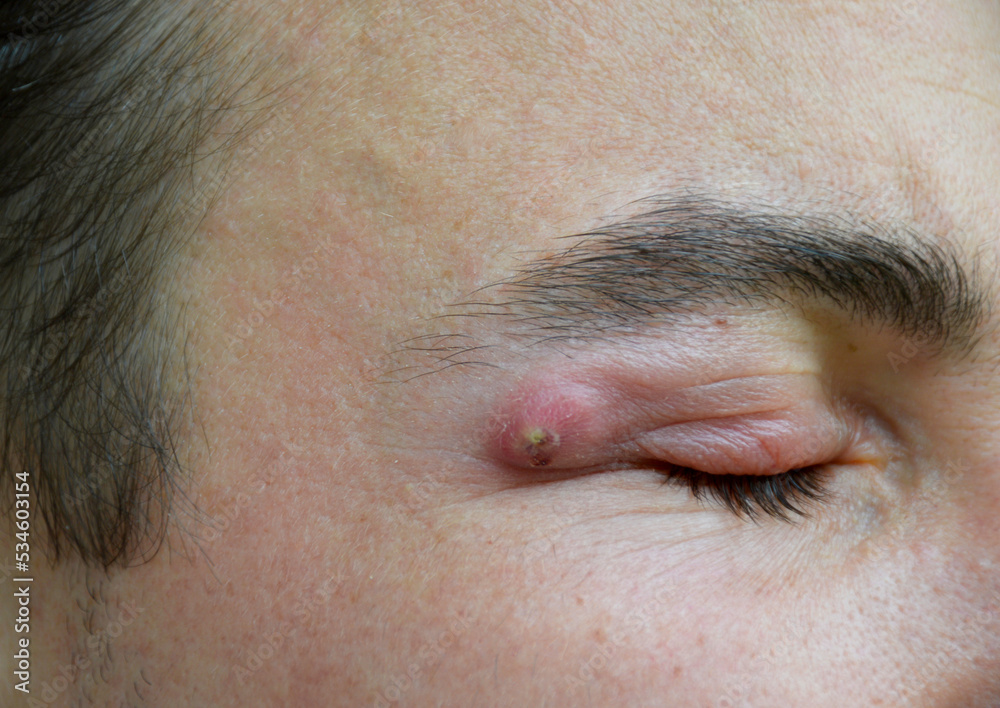 boil - a strong purulent abscess in a man near the eye. swelling from ...