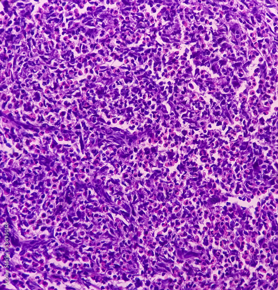 Photomicrograph of lymph node with Hodgkin's Disease (lymphoma ...