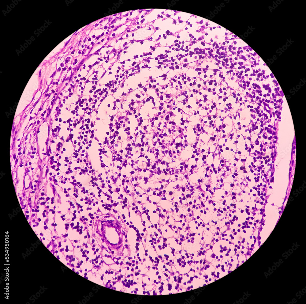 Photomicrograph of lymph node with Hodgkin's Disease (lymphoma ...