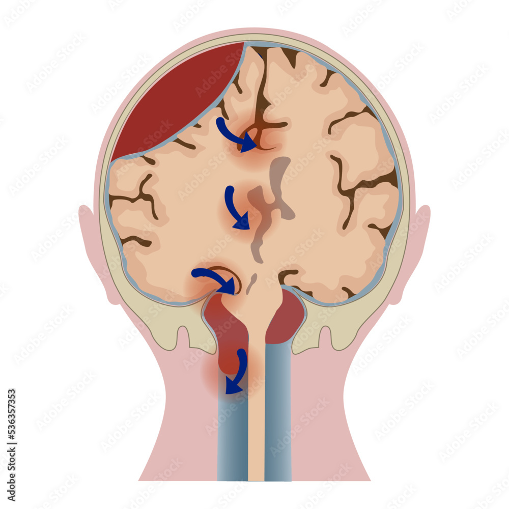 Brain hematoma with tissue distortion. Sectioned head. Medical poster ...