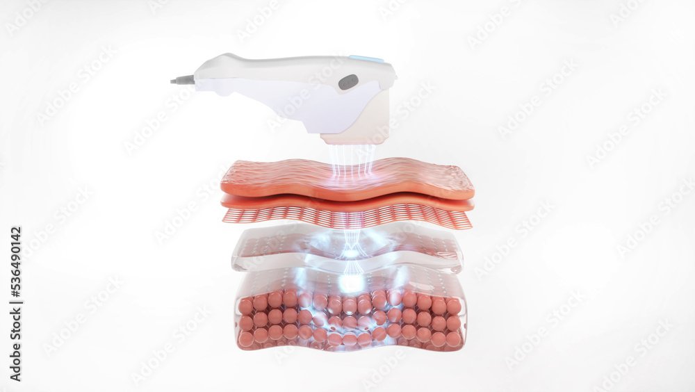 Hifu laser machine shot laser through skin surface to SMAS layer to ...