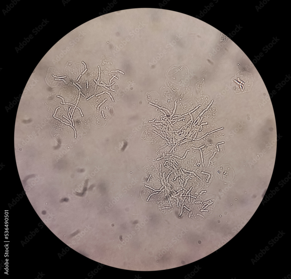 Microscopic fungi Malassezia furfur, showing yeast cells and hyphae ...
