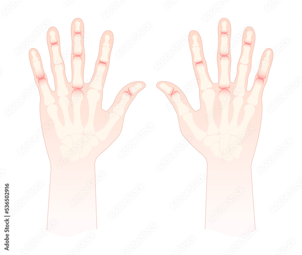 chronic Hand Pain joint inflammatory with facial butterfly and malar ...