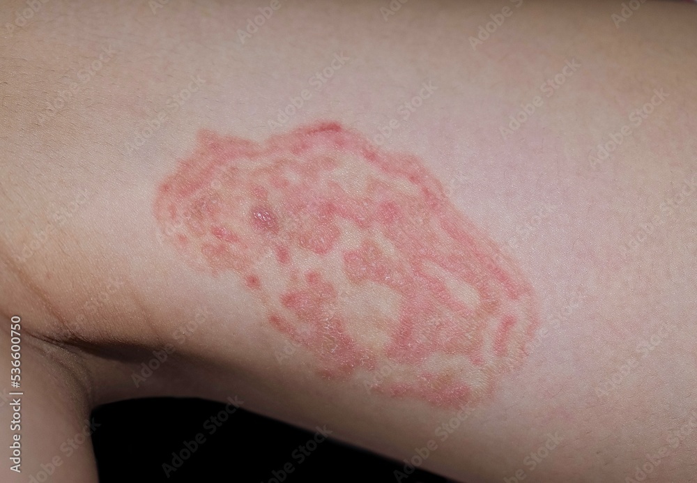 Fungal infection called tinea corporis in thigh of Asian child ...