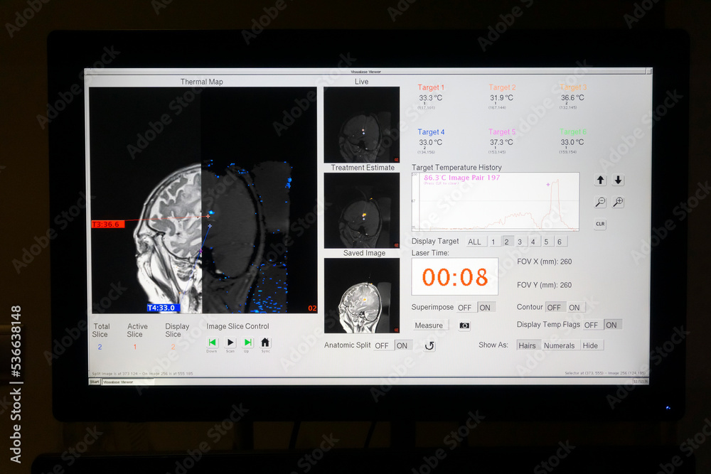 Step by step Visualase is an MRI-guided laser ablation system used to ...