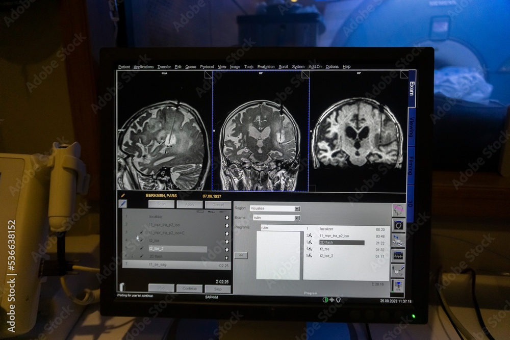 Stock-Foto „Step by step Visualase is an MRI-guided laser ablation ... Stock-Foto „Step by step Visualase is an MRI-guided laser ablation ...