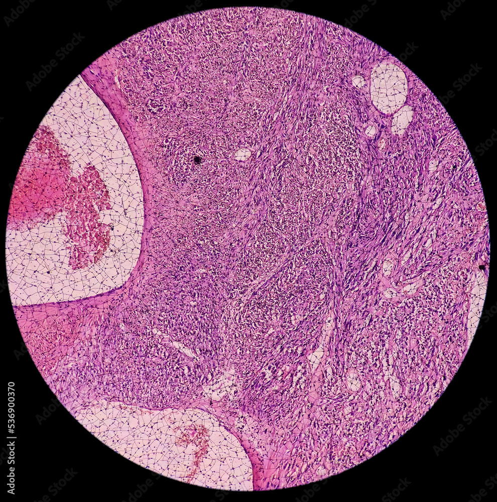 Small intestine mass(biopsy): Malignant gastrointestinal stromal tumor ...