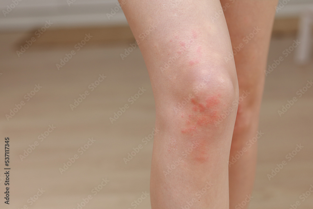 skin allergies, legs skin women. Closeup of red pustules on a knee, an ...