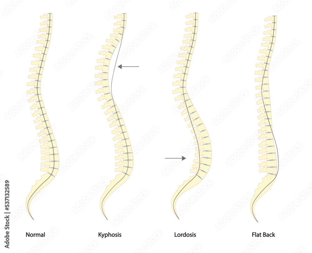 Spine deformity types and normal spine comparison. Lateral view of ...