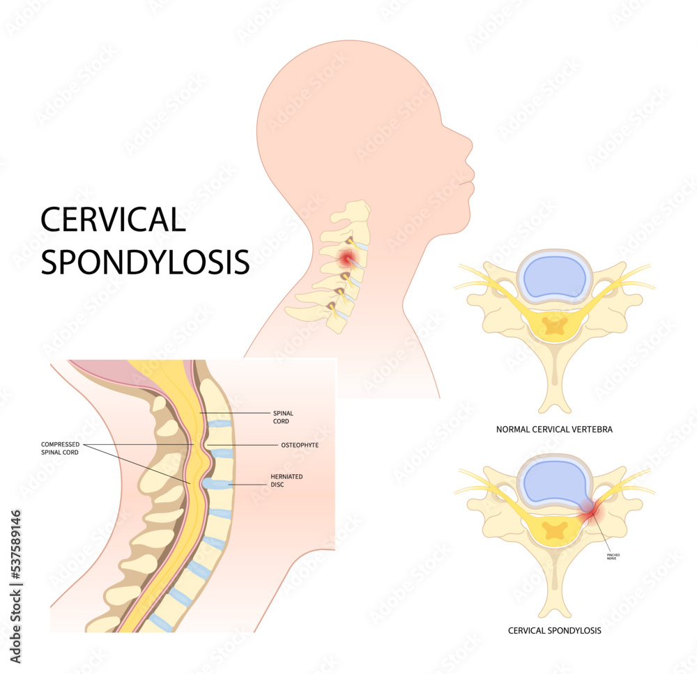 Spinal cord pinched nerves and painful Tingling Numbness hand of ...