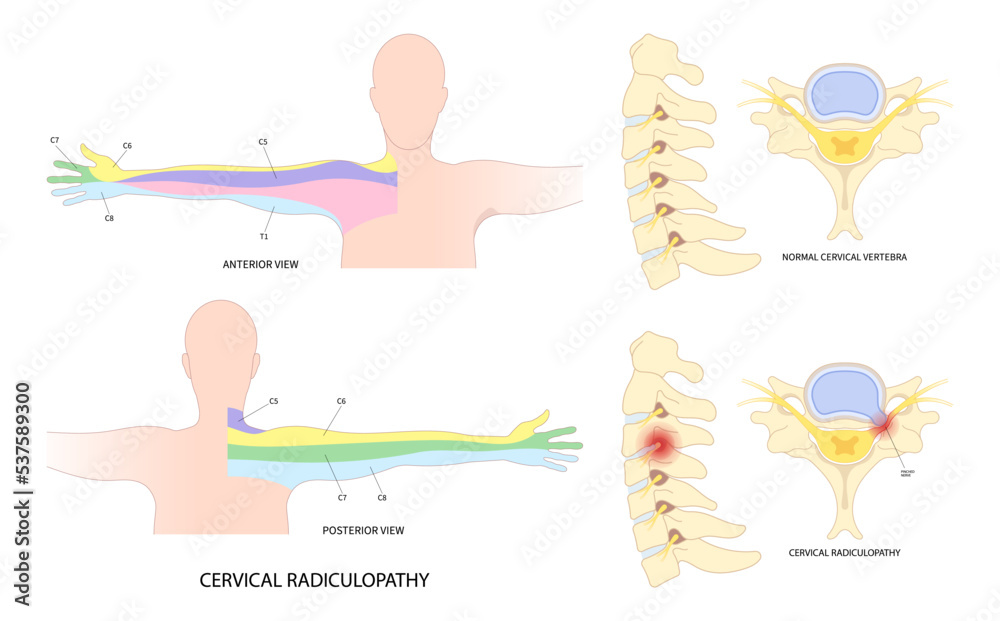 Herniation bone disk of neck and thoracic outlet syndrome root injury ...