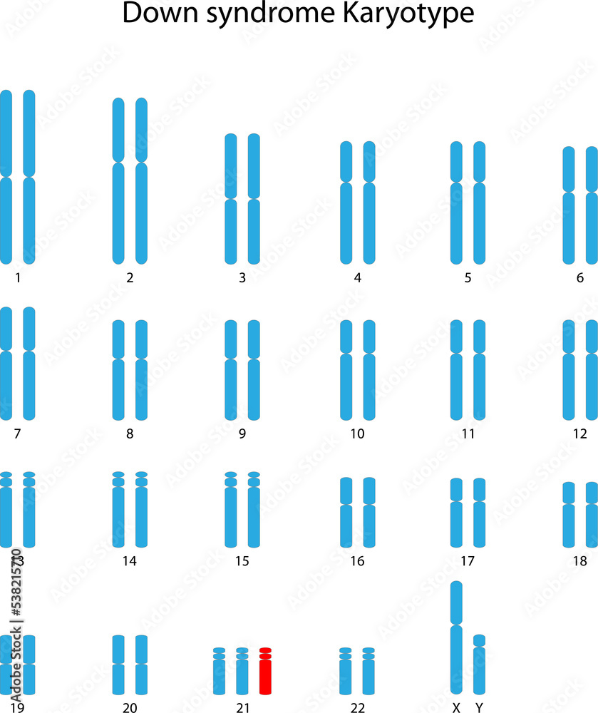Down syndrome (trisomy 21) human karyotype Stock Illustration | Adobe Stock