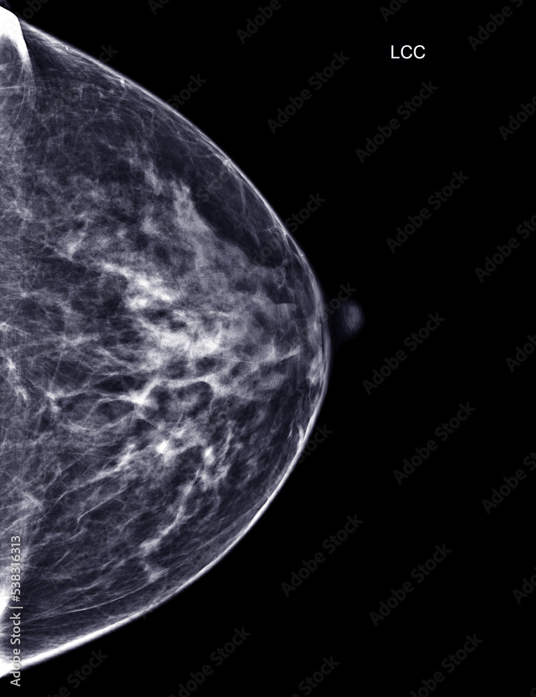 X-ray Digital Mammogram or mammography of both side breast Standard ...