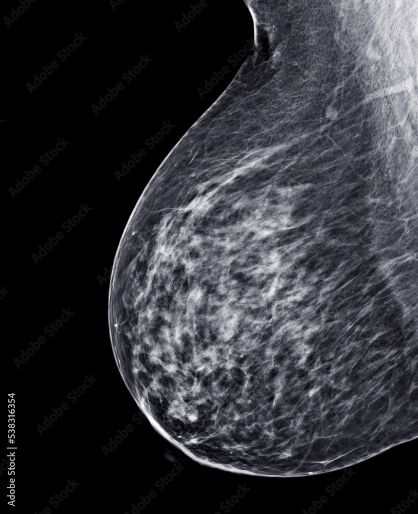 X-ray Digital Mammogram or mammography of both side breast Standard ...