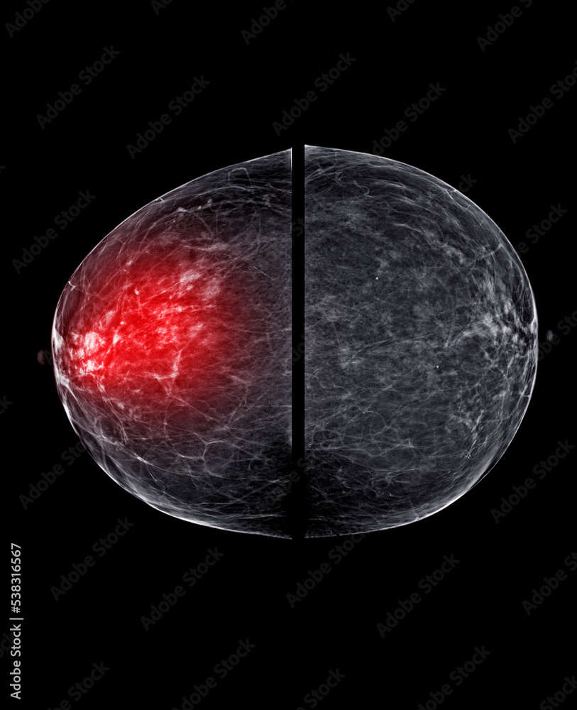 X-ray Digital Mammogram or mammography of both side breast Standard ...