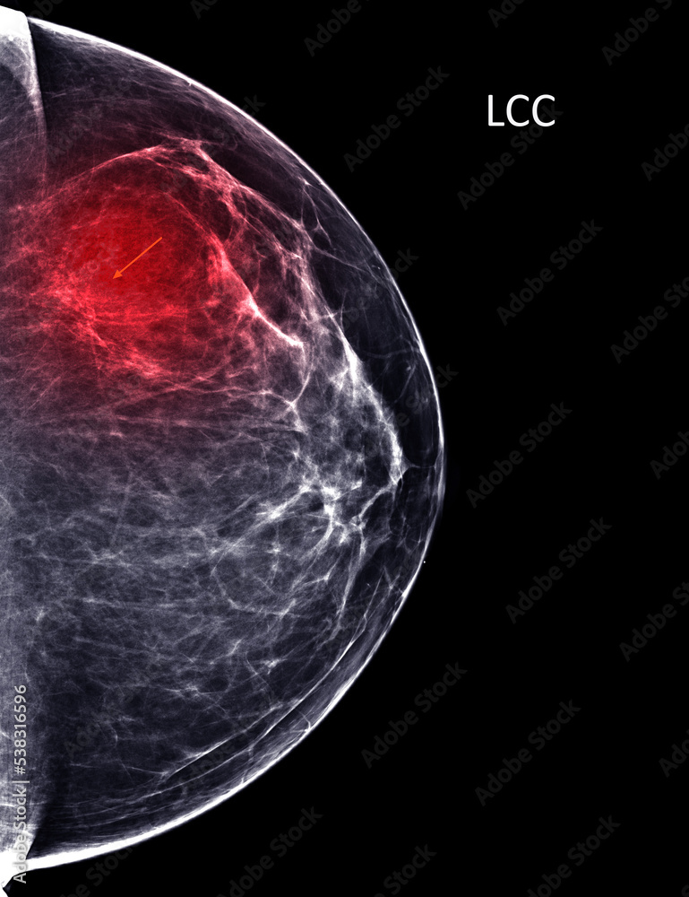 X-ray Digital Mammogram or mammography of both side breast Standard ...