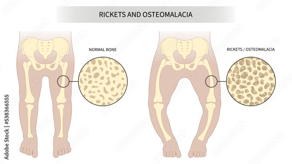 The rickets Blount's and Paget's disease of hip low density lack ...