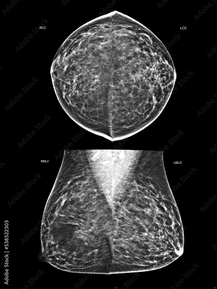 X-ray Digital Mammogram or mammography of both side breast Standard ...