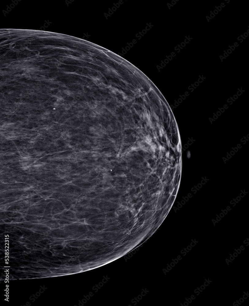 X-ray Digital Mammogram or mammography of both side breast Standard ...