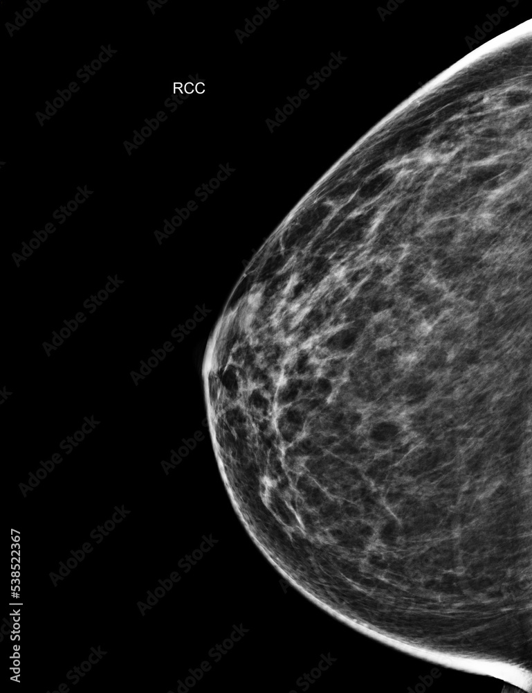 X-ray Digital Mammogram or mammography of both side breast Standard ...