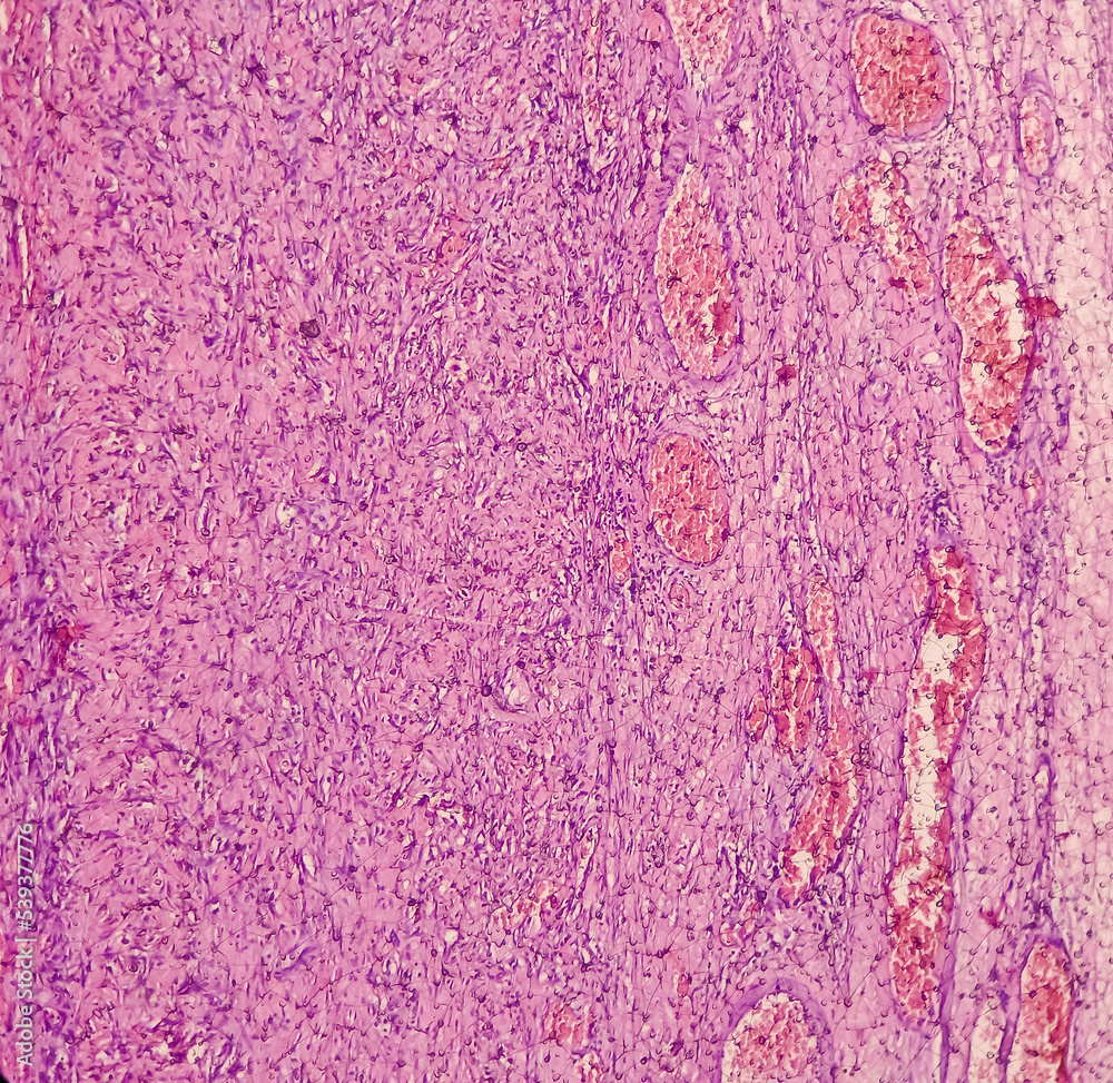Testis biopsy, testicular infarction, disease of male genital organs ...