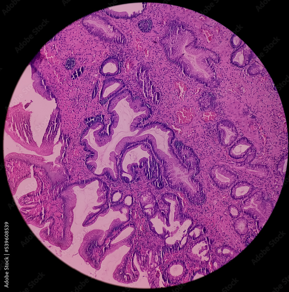 Gastric polyp biopsy: Adenomatous polyps. Showing gastic mucosa, a ...