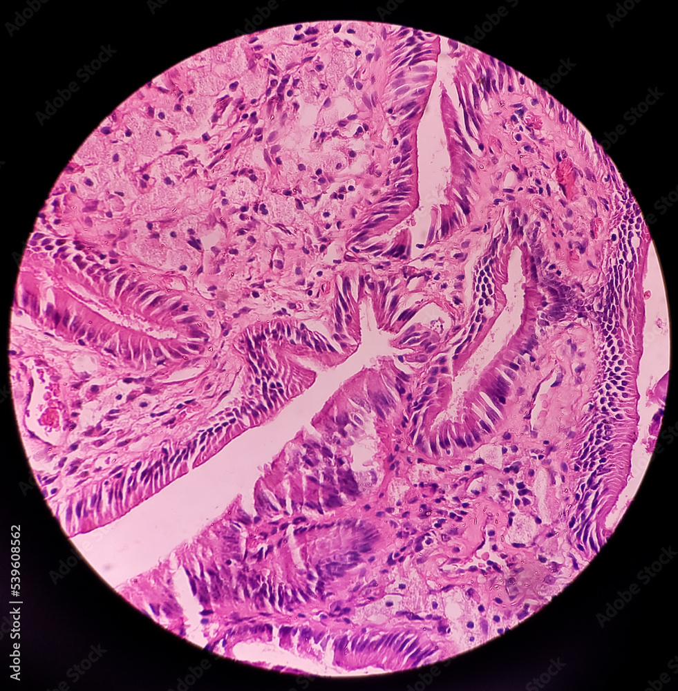 Cholelithiasis of Gallbladder, microphotograph of chronic cholecystitis ...
