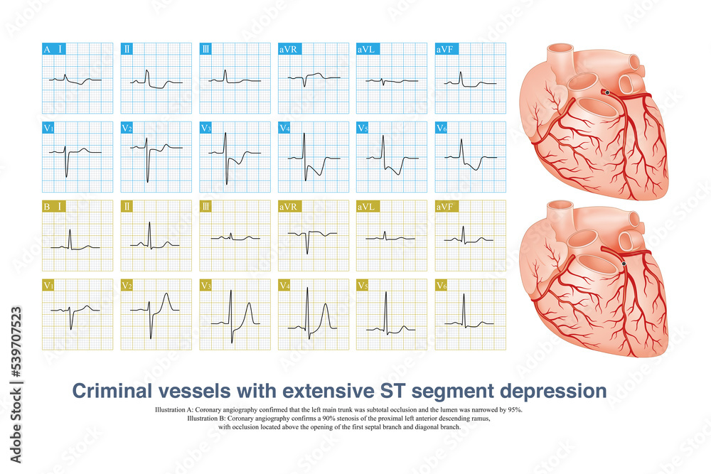 In case of acute coronary syndrome, if the ECG shows extensive ST segment depression, the ...