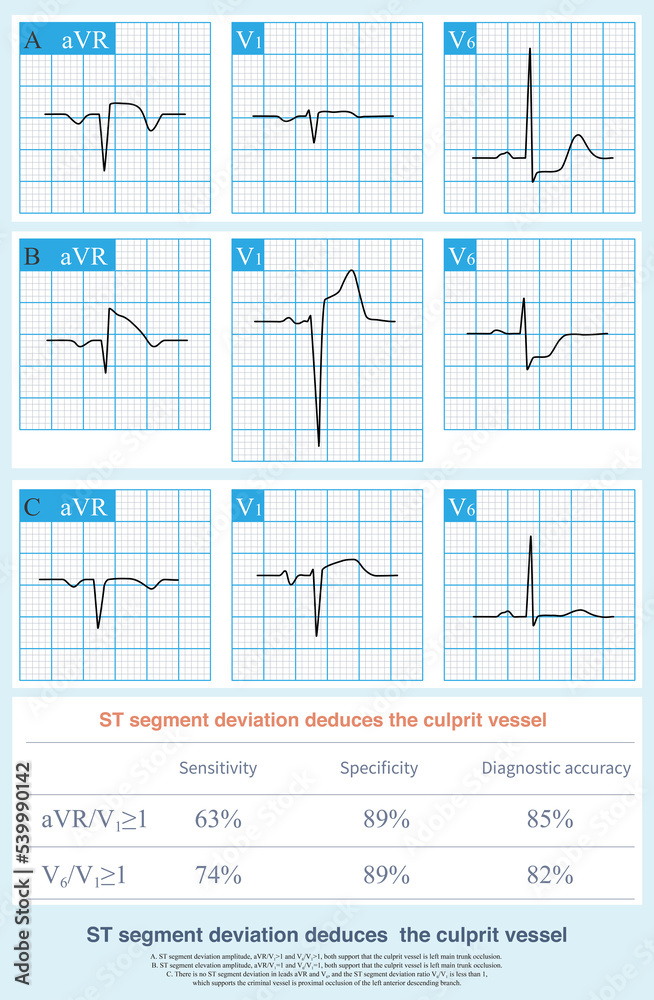 On ECG, in case of acute myocardial infarction, the ST segment ...