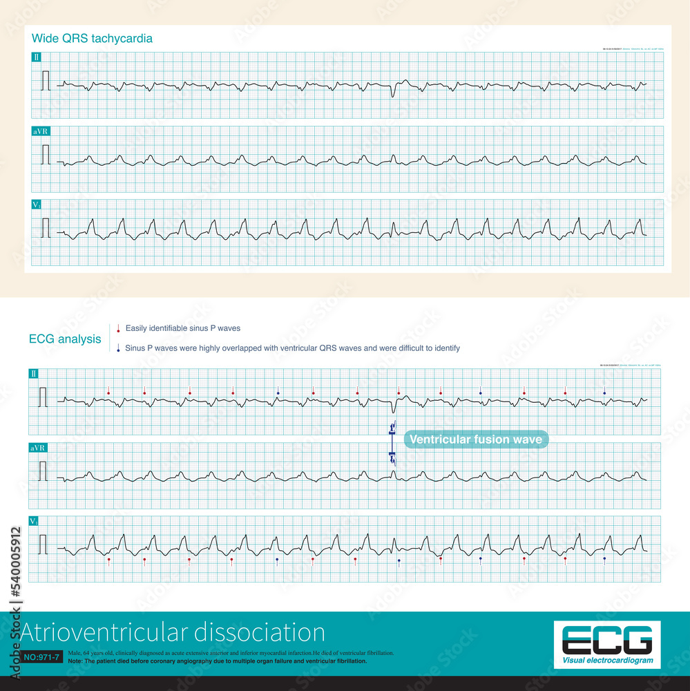 Illustration Stock If atrioventricular dissociation and ventricular ...