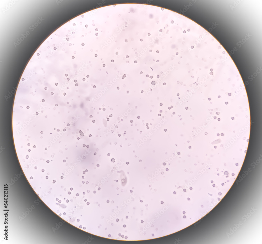 Abnormal result of urinalysis examination from microscopic method under ...