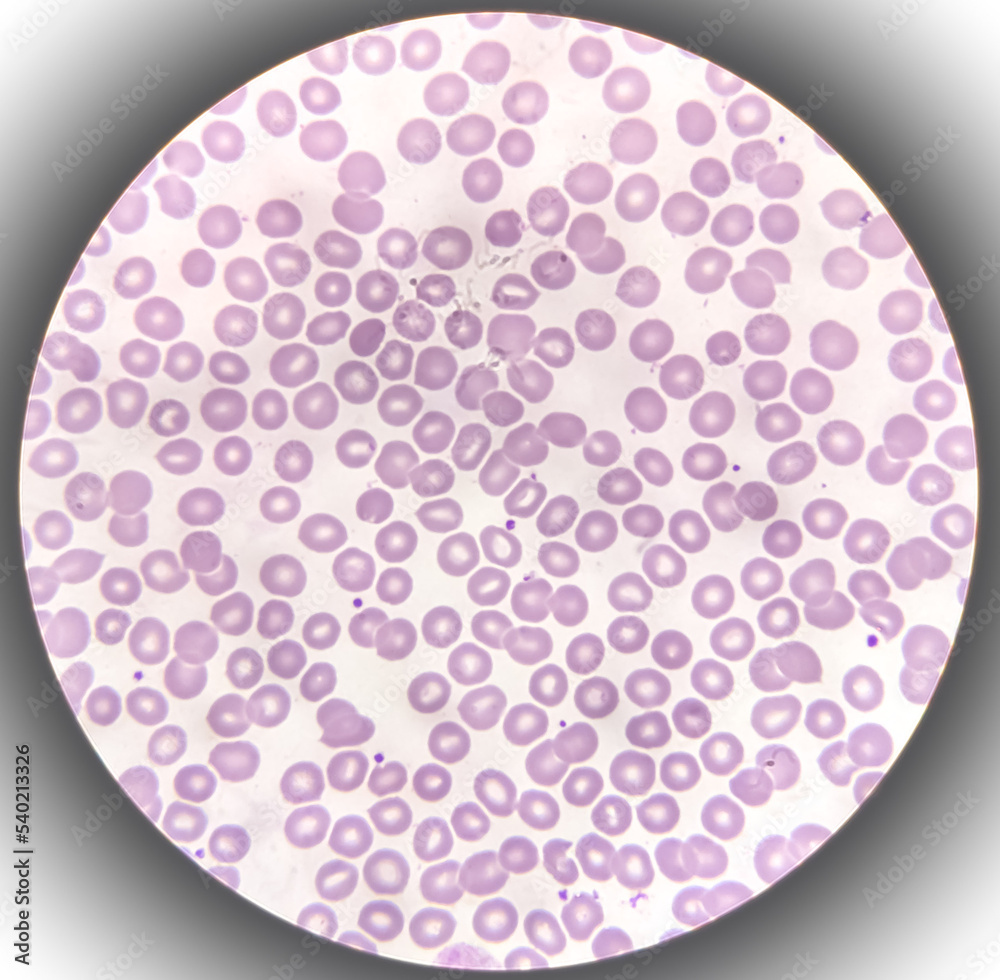 Stock-Foto „Target cells with abnormal red blood cells from anemia ...