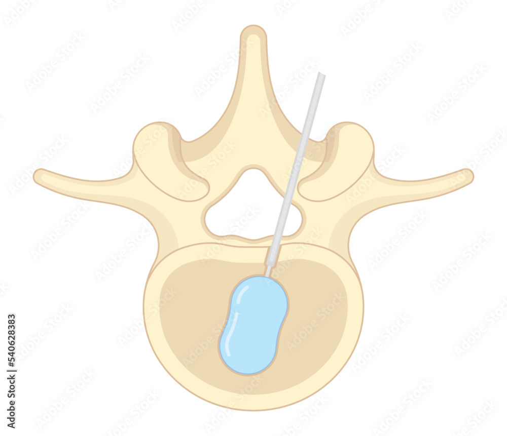 posture hunched back and vertebral column bone disk joint neck pain ...