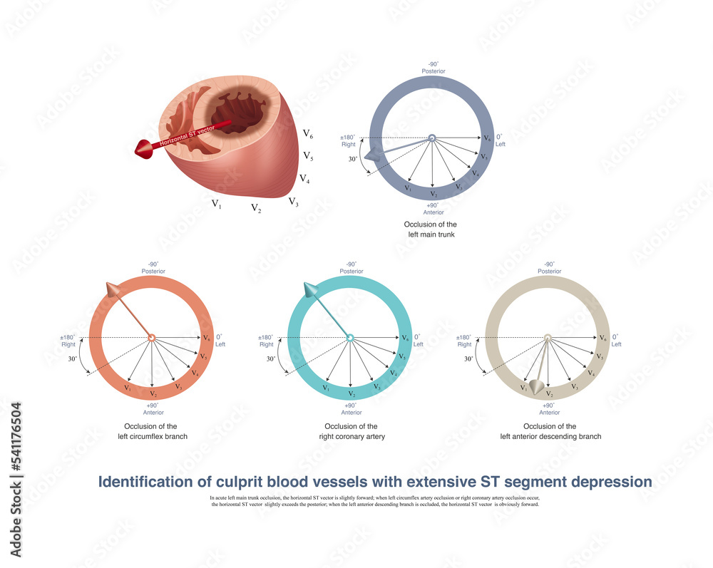 Illustration Stock When extensive ST segment depression occurs, the ...